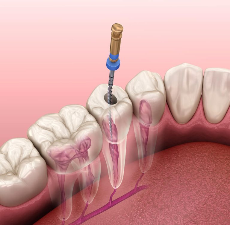 How Does Root Canal Work in Jones Creek, LA | Read Our Blog